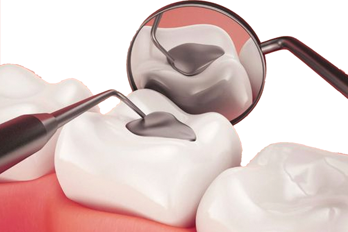 Fillings for kids - JNJ Dental Care