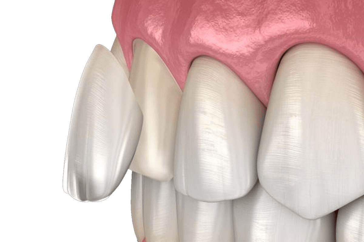 Veneer - JNJ Dental Care